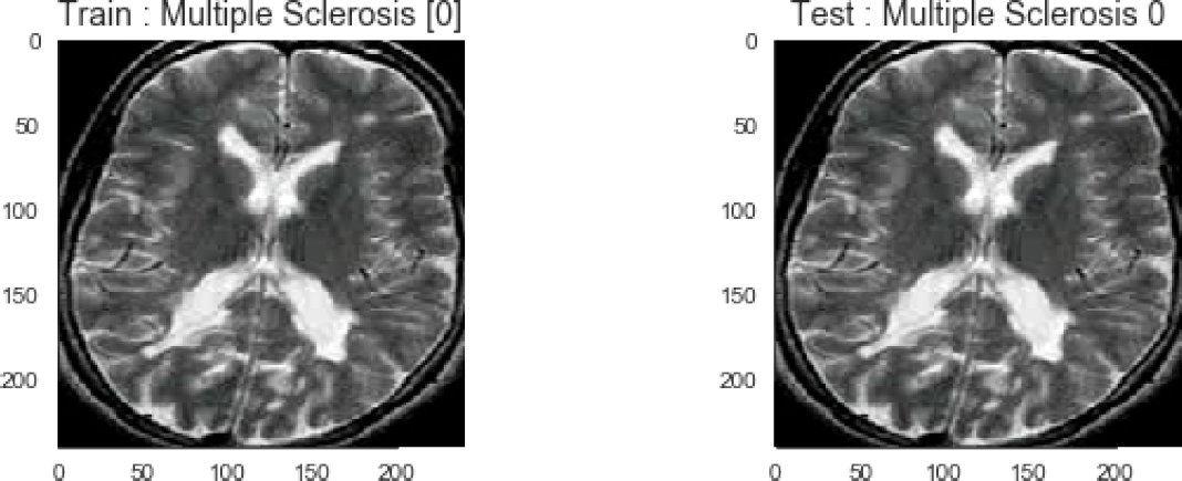 Detection and Classification of Multiple Sclerosis from Brain MRIs by ...