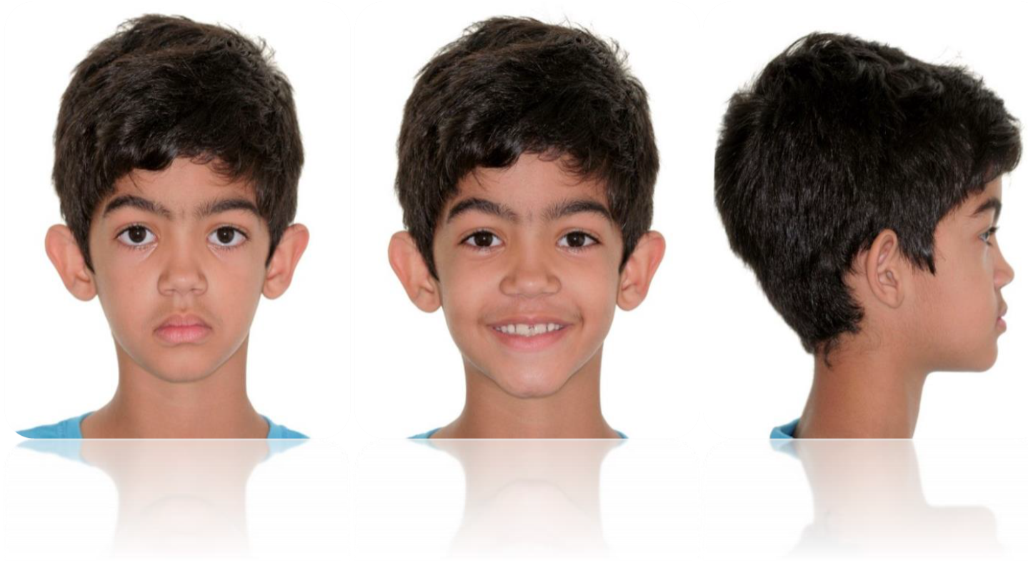 Maloclusión esquelética clase III con deficiencia maxilar. Mascara de ...