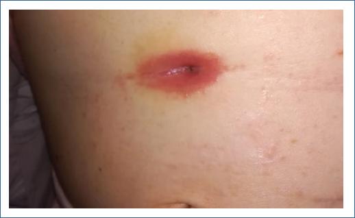 Cierre endoscópico de fístula gastrocutánea posterior al retiro de ...