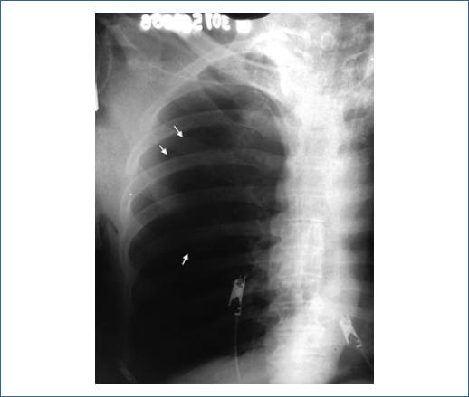 Perforación gástrica secundaria a resucitación cardiopulmonar: reporte ...