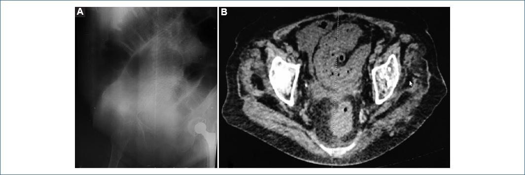 Colitis Fulminante secundaria a infección por Clostridium Difficile en ...