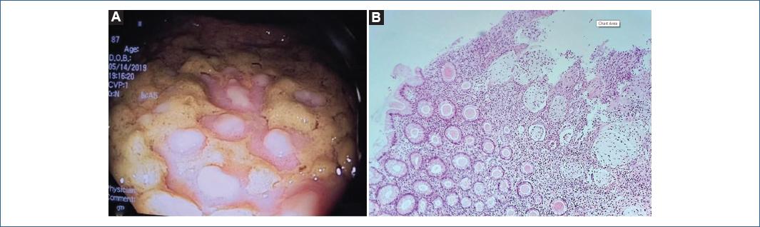 Colitis Fulminante secundaria a infección por Clostridium Difficile en ...