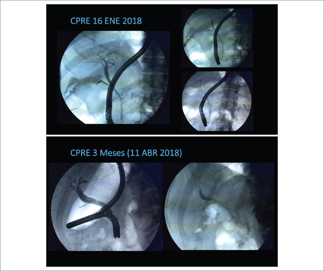 Manejo endoscópico de fuga biliar pos colecistectomía: ¿es necesaria la ...