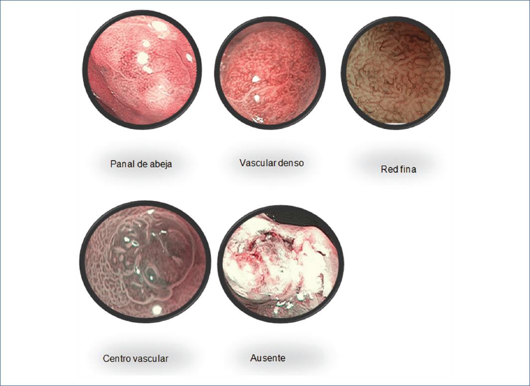Correlación de la imagen de banda estrecha con la histopatología de los ...