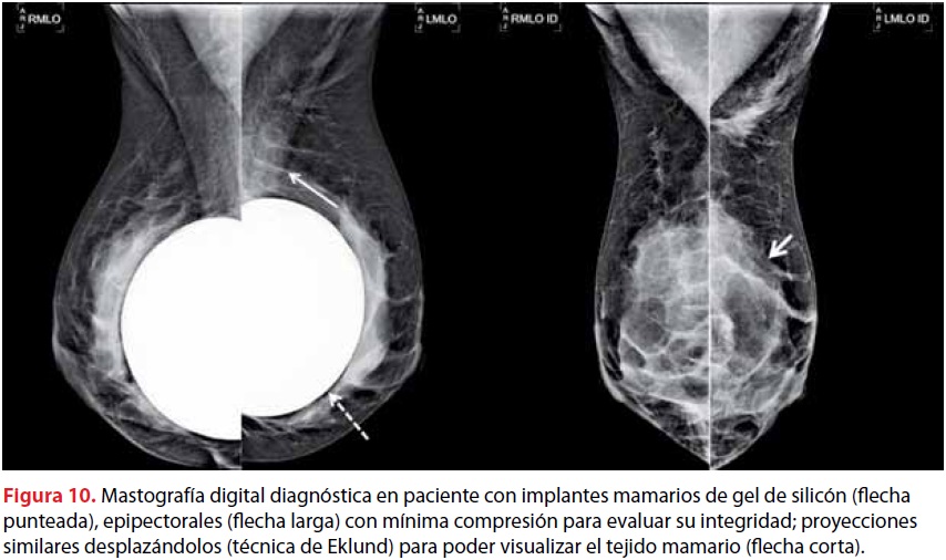 Detección temprana y diagnóstico del cáncer mamario