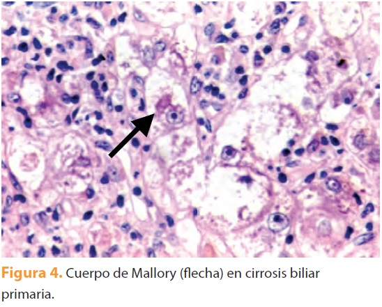 El centenario de la descripción de los cuerpos de Mallory