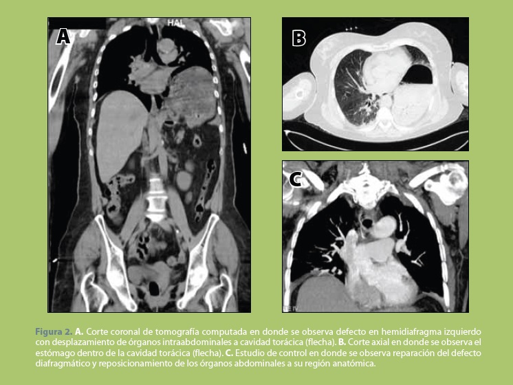 Hernia diafragmática secundaria a trauma abdominal cerrado