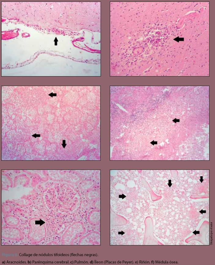 Fiebre entérica en fase de fastigium: notas epicríticas acerca de un ...