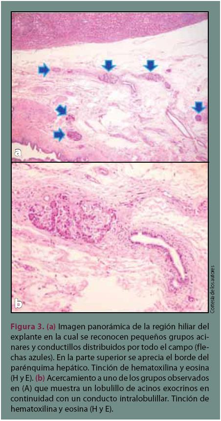 Heterotopia pancreática yeyuna yuxtahepática y en quiste de conducto ...
