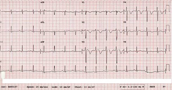 Síndrome de Wellens