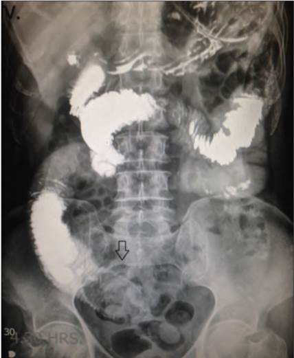 Íleo biliar, una causa infrecuente de oclusión intestinal. Presentación ...