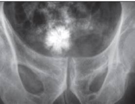 Textiloma y cicatriz patológica