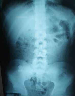 Fecalito como signo radiológico en la apendicitis aguda