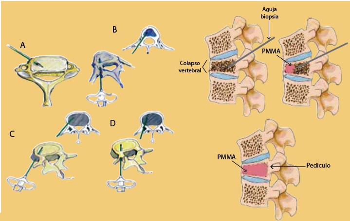 Manejo del dolor óseo