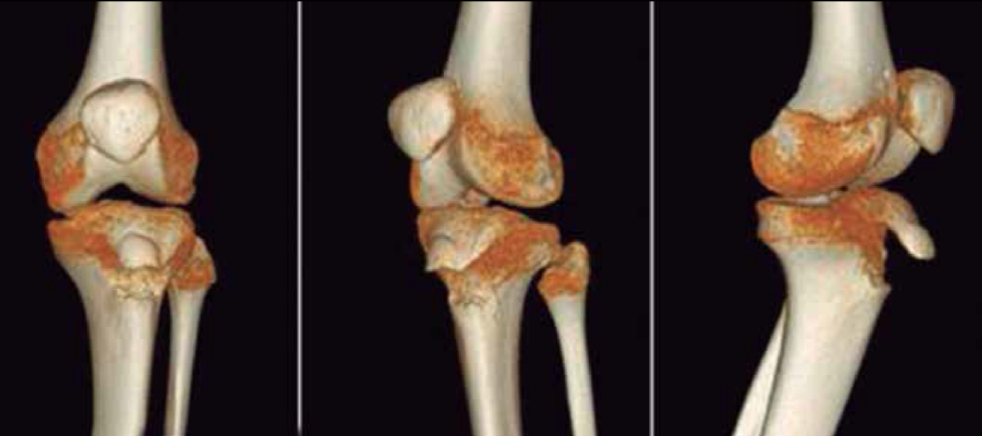 Anatomía De La Superficie De La Tuberosidad Tibial