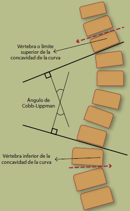 Detección temprana de la escoliosis idiopática del adolescente: una ...