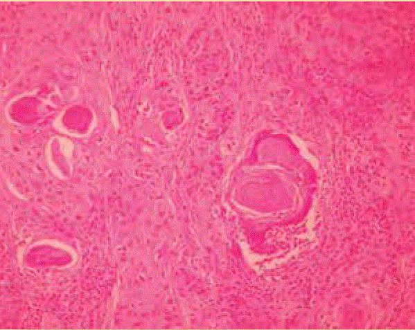 Cáncer epidermoide en piel cabelluda, presentación inusual. Reporte un caso