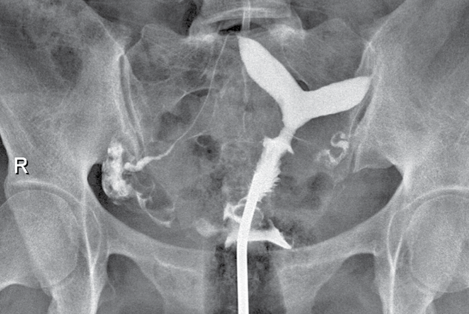 Útero bicorne. Reporte de caso