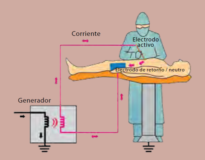 Quemadura secundaria a incorrecta colocación de placa de electrocauterio