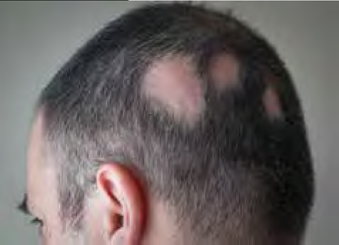 El pelo: generalidades y enfermedades más comunes