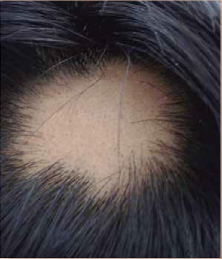 El pelo: generalidades y enfermedades más comunes