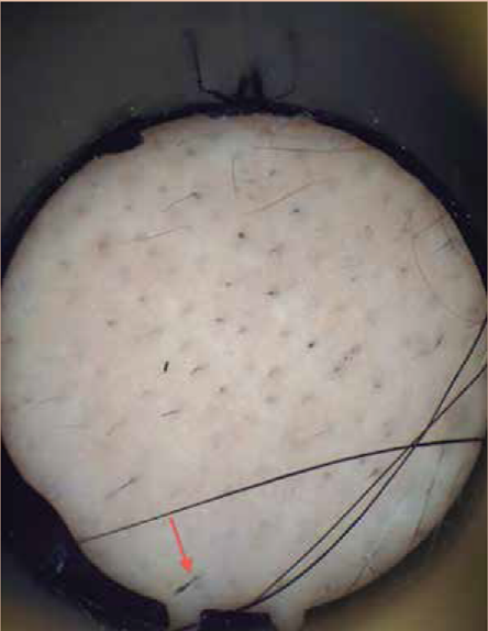 El pelo: generalidades y enfermedades más comunes