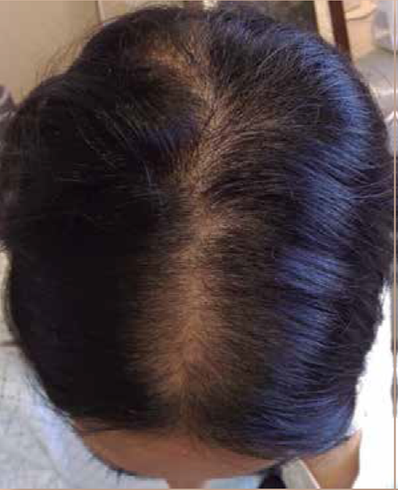 El pelo: generalidades y enfermedades más comunes
