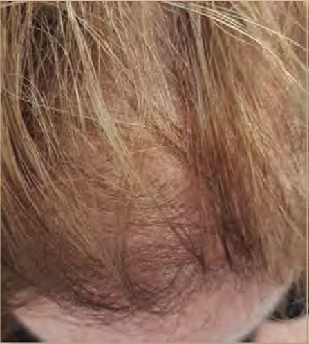 El pelo: generalidades y enfermedades más comunes