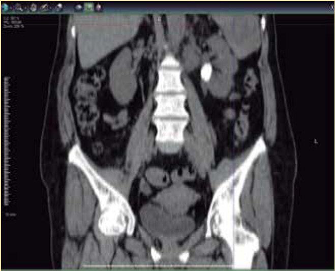 Tratamiento contemporáneo de la litiasis renal piélica: a propósito de ...