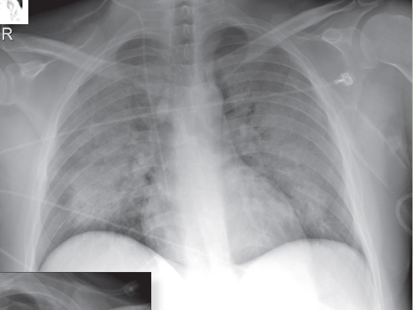 Radiografía De Edema Pulmonar