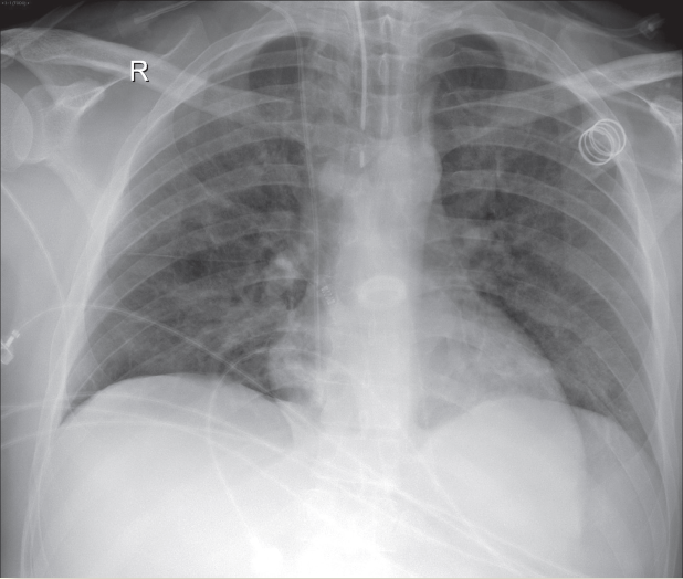 Edema Pulmonar Radiografia De Torax
