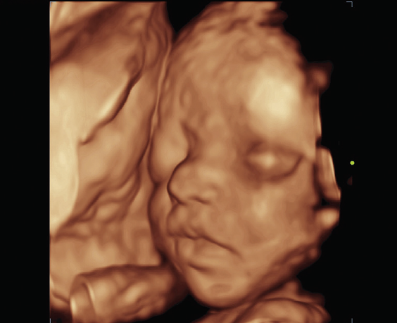 Muerte fetal por negligencia médica