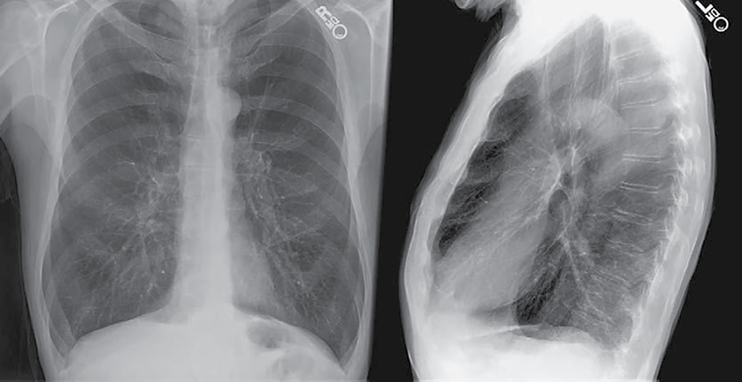Enfermedad pulmonar obstructiva crónica (EPOC). Bases para el médico ...