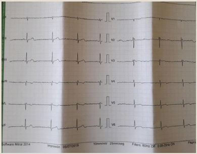 Características clínicas de anorexia nervosa extrema. Reporte de caso