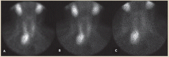 Escisión transcervical de un adenoma paratiroideo mediastínico gigante