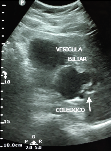 Quiste de colédoco Todani IVa. Reporte de caso y revision de la literatura