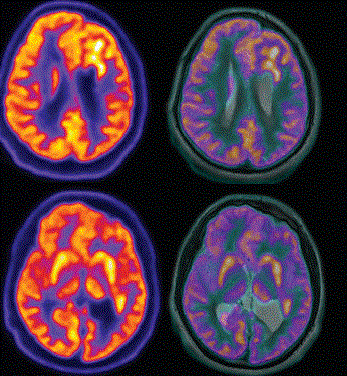 Signo de “doble corteza” visualizado en corregistro 18F-FDG PET/RM en ...