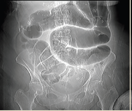 “Sigma Volvere” acerca del vólvulo de sigmoides, diagnóstico y manejo ...