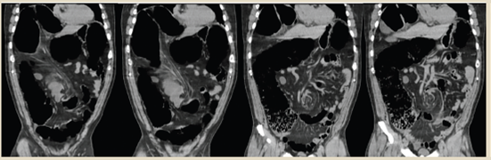 “Sigma Volvere” acerca del vólvulo de sigmoides, diagnóstico y manejo ...