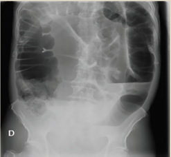 “Sigma Volvere” acerca del vólvulo de sigmoides, diagnóstico y manejo ...