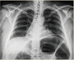 “Sigma Volvere” acerca del vólvulo de sigmoides, diagnóstico y manejo ...