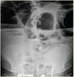 “Sigma Volvere” acerca del vólvulo de sigmoides, diagnóstico y manejo ...