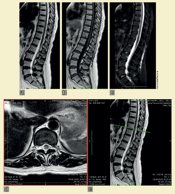 Mielitis transversa aguda asociada con infección por SARS-CoV-2