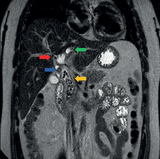 Litiasis masiva de la vía biliar intra y extra hepática. Reporte de 2 casos