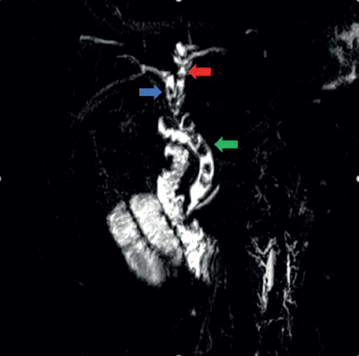 Litiasis masiva de la vía biliar intra y extra hepática. Reporte de 2 casos