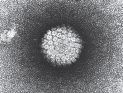 Tumor de Buschke-Löwenstein en el embarazo adolescente