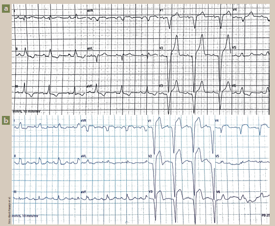 Electrocardiograma Ecg En Infarto De Miocardio Iam 1080x1438