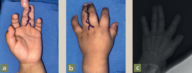 “Unum digitum”:Caracterización clínica y radiológica de la sindactilia ...