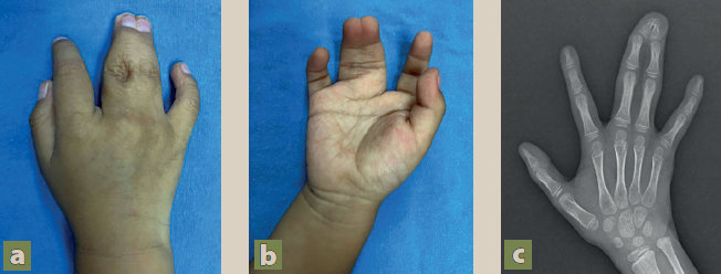 “Unum digitum”:Caracterización clínica y radiológica de la sindactilia ...