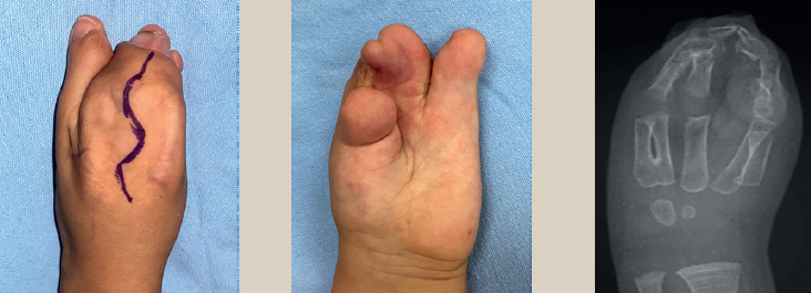 “Unum digitum”:Caracterización clínica y radiológica de la sindactilia ...